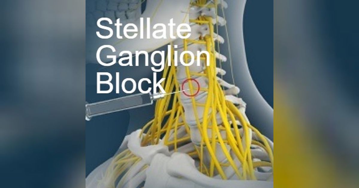 Stellate Ganglion Block For Trauma And PTSD Interview With Dr James Stellate Ganglion Block For Trauma And PTSD Interview With Dr James