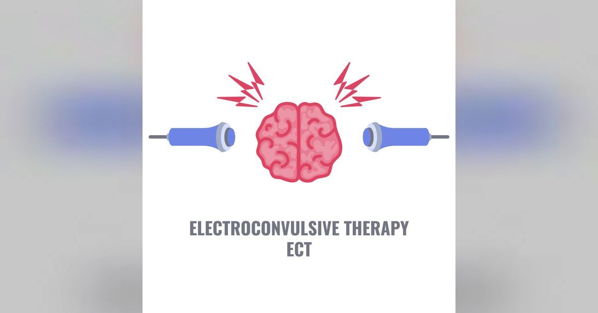 Electric Insights: Understanding Electroconvulsive Therapy (ECT) | Mind ...
