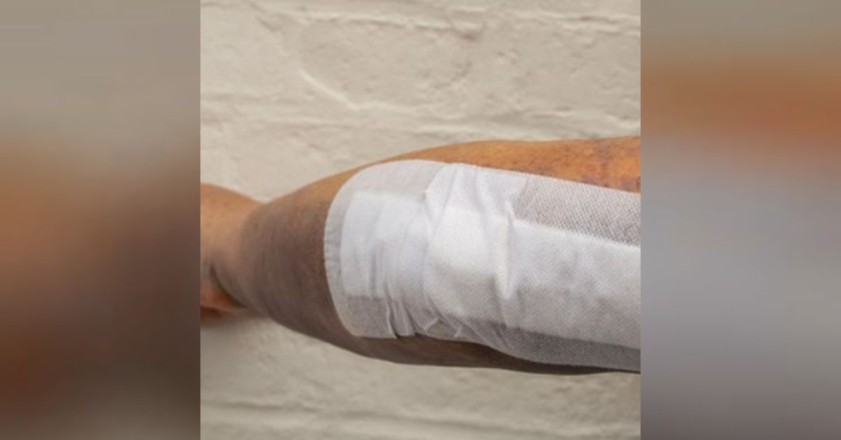 Kerecis Omega 3 Skin Substitute: Advanced Graft Application for Better ...