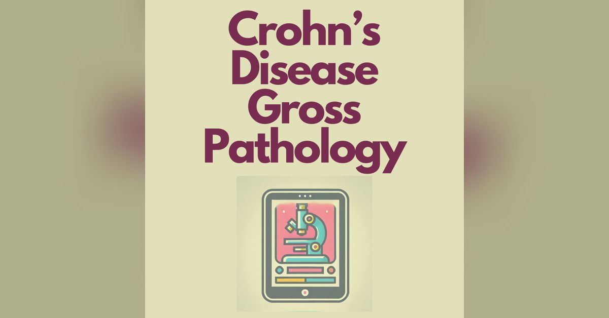 Crohn's Disease: A Subtotal Colectomy Case Study | Deeper Levels ...