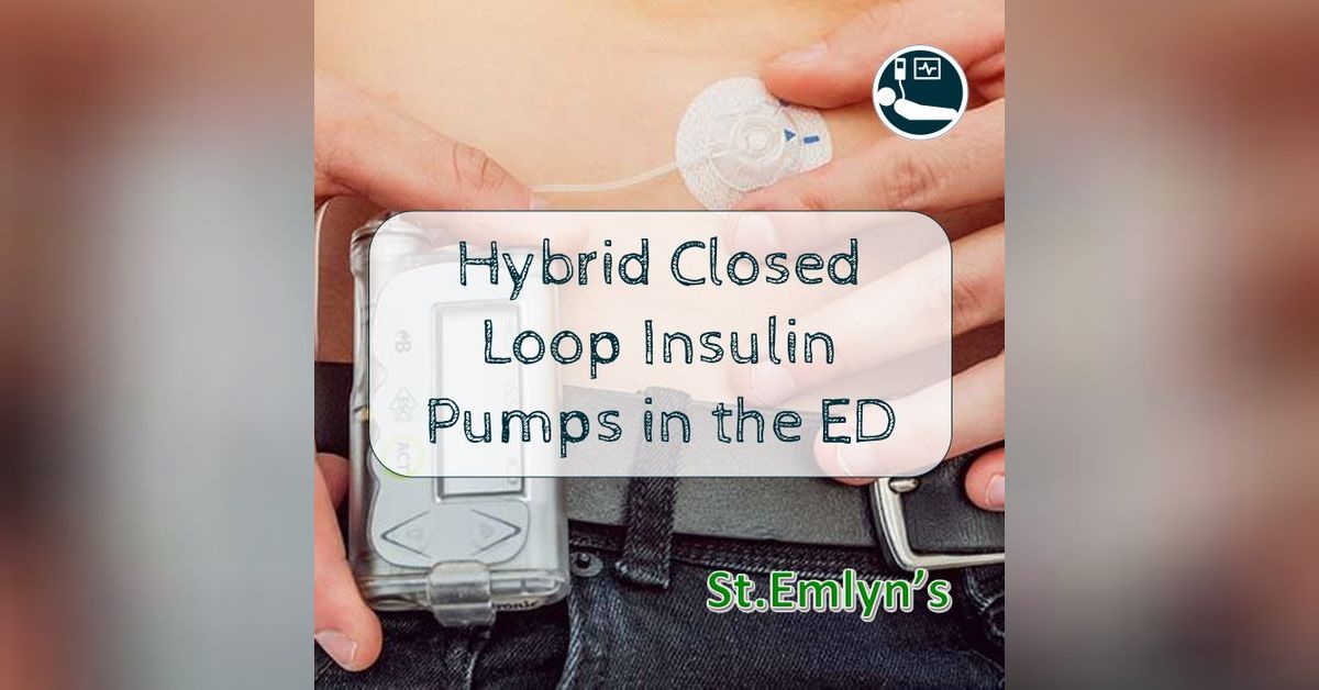 Ep 237 - Hybrid Closed Loop Insulin Pumps with Nicola Trevelyan at ...