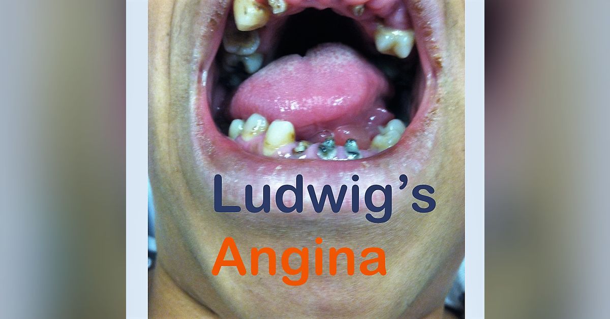 Ludwig's Angina- more than a toothache | The DownEast Emergency ...